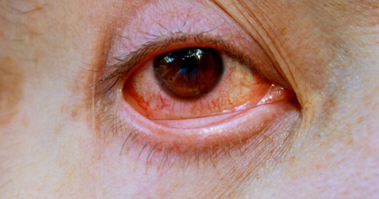 Eye Doctor Approved Causes of Eye Redness